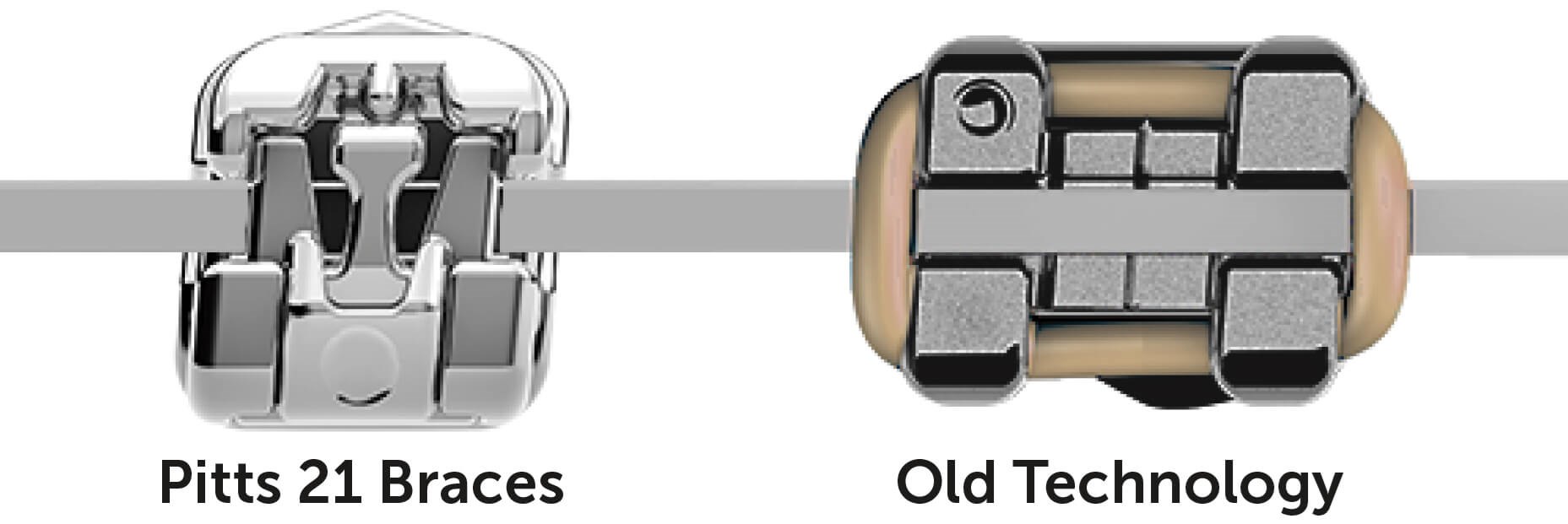 Definitely Not Your Parents' Braces! | RxSmile Frisco Orthodontist ...