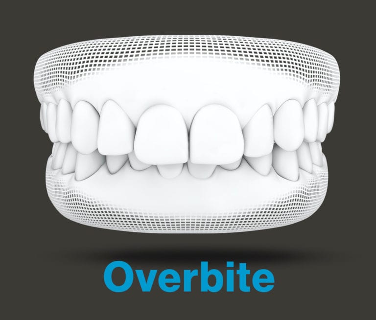 Invisalign Clear Aligners in Frisco, TX | RxSmile Frisco Orthodontist ...
