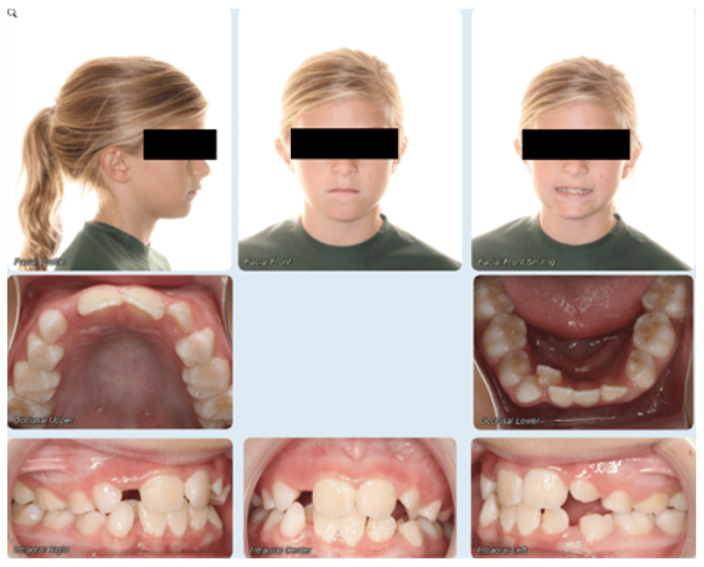 Uncovering a Mesiodens with 3D Visualization | RxSmile Frisco ...