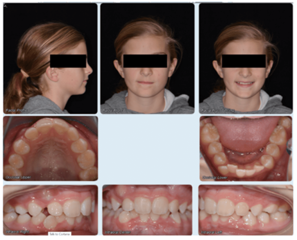 Uncovering a Mesiodens with 3D Visualization | RxSmile Frisco ...